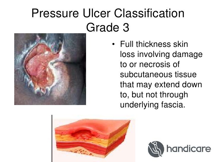 Reducing the incidence of pressure sores and shearing damage for bed-…
