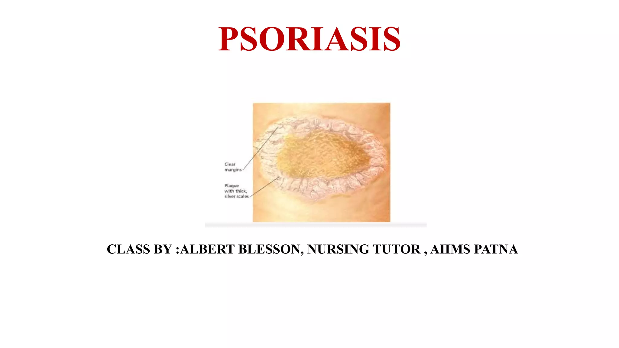 psoriasis | PPT