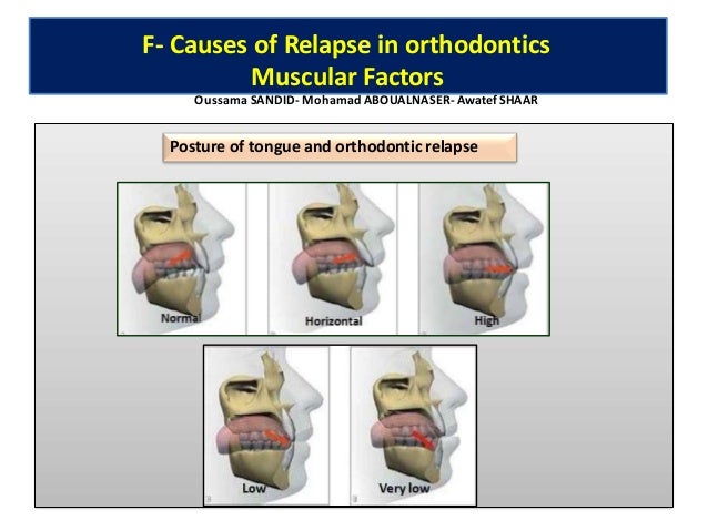 141 relapse in orthodontics-recidives en orthodontie-oussama sandid-m…