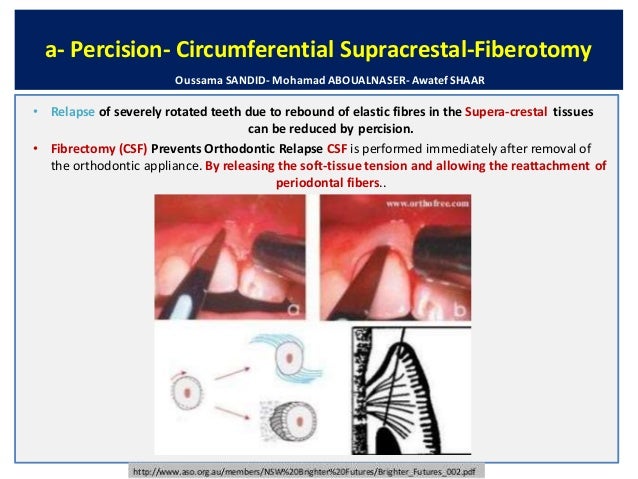 141 relapse in orthodontics-recidives en orthodontie-oussama sandid-m…