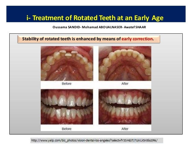 141 relapse in orthodontics-recidives en orthodontie-oussama sandid-m…