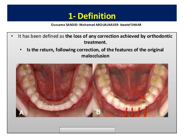 141 relapse in orthodontics-recidives en orthodontie-oussama sandid-m…