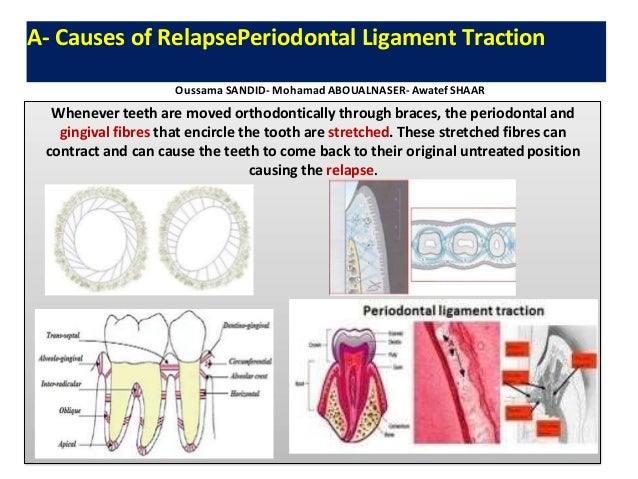 141 relapse in orthodontics-recidives en orthodontie-oussama sandid-m…