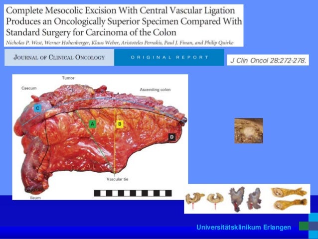 Standardized Surgery for Colonic Cancer - Complete Mesocolic Excision…