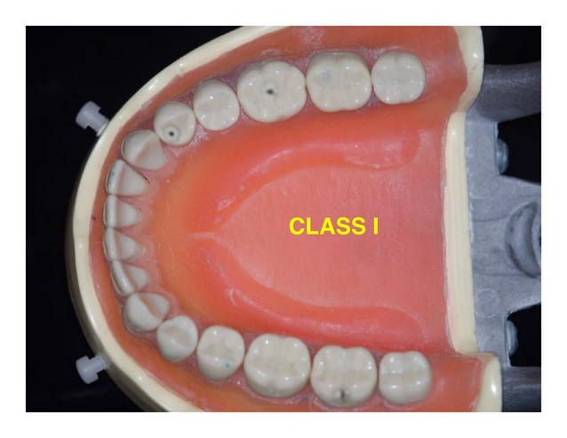class i amalgam cavity design | PPT