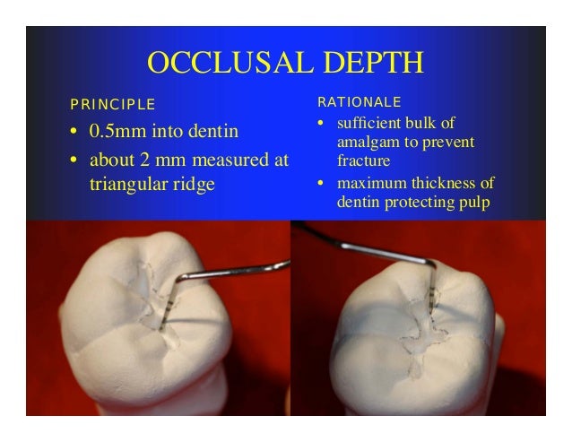 class i amalgam cavity design