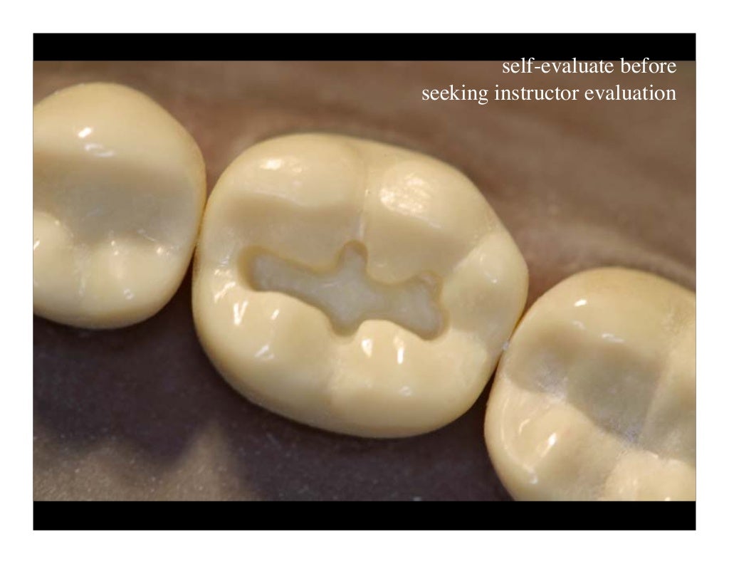 class i amalgam cavity design