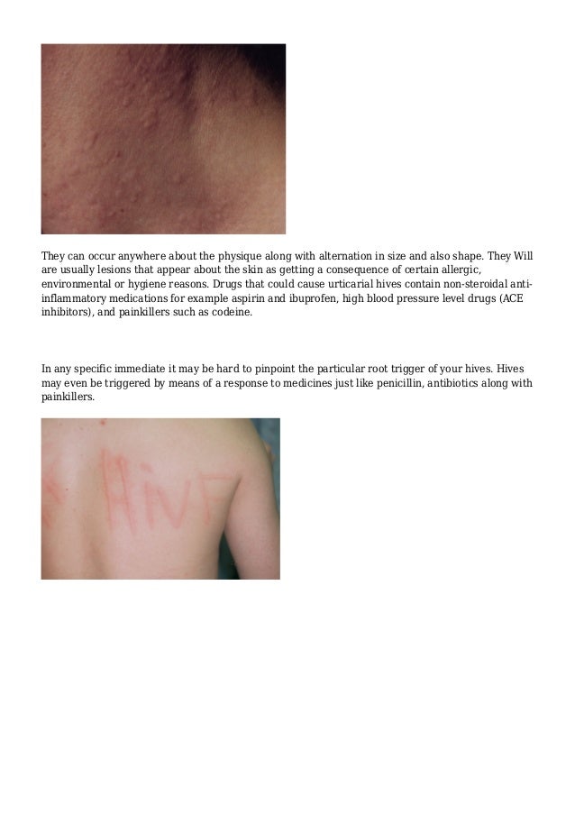 The recommended approach for treating ones Dermatographic Urticaria is ...