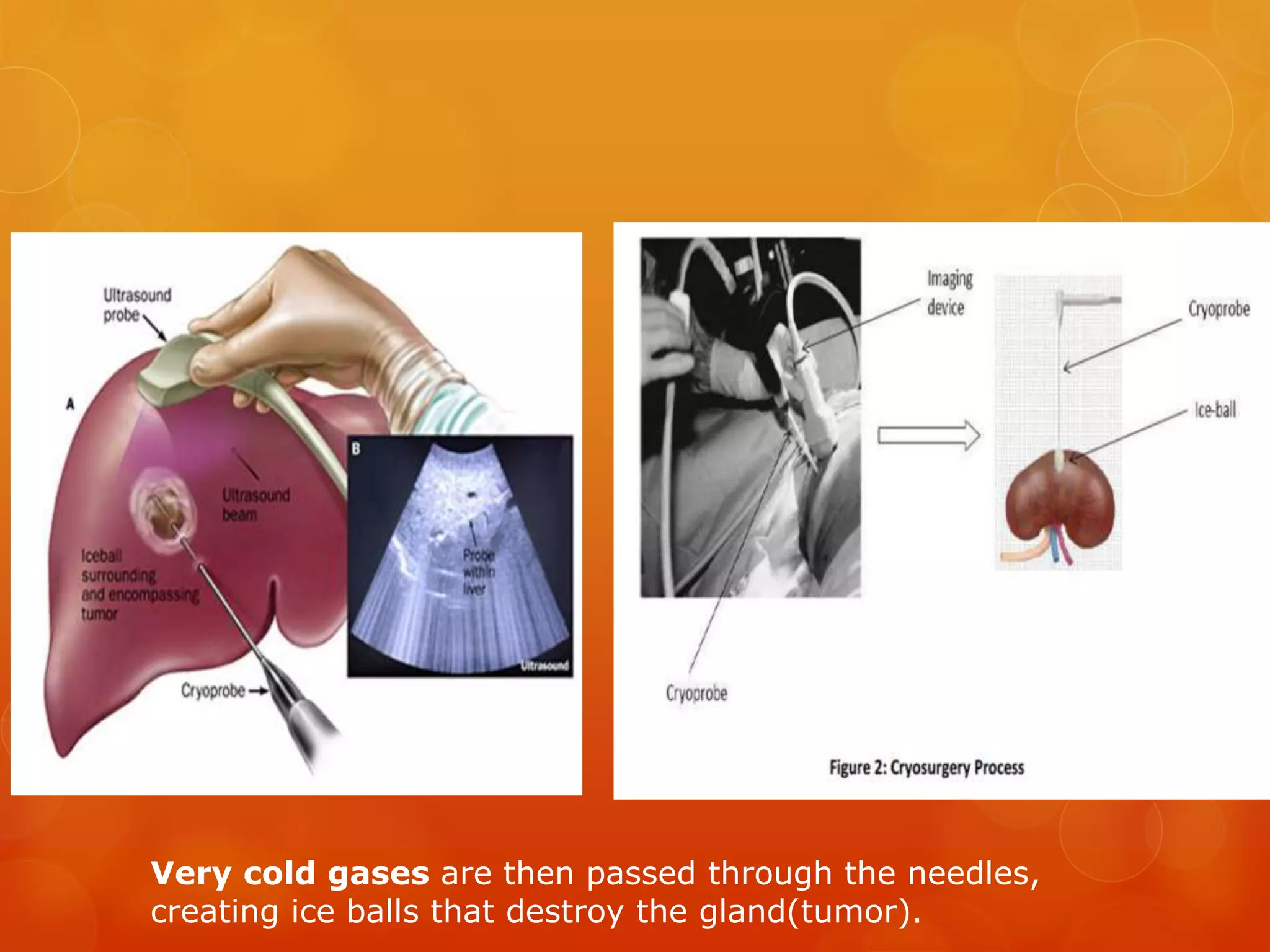 CRYOSURGERY BY DR SUCHITRA SURYAVANSHIPATIL | PPTX