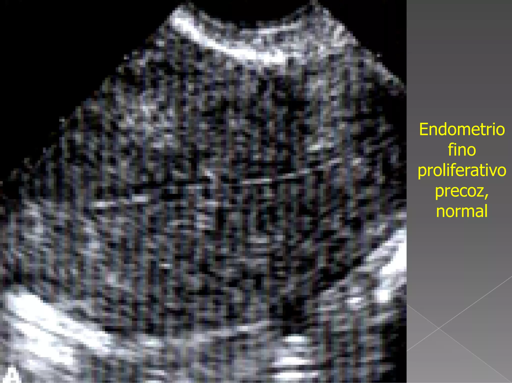 Ecografía del Endometrio | PDF | Pregnancy | Reproductive Health