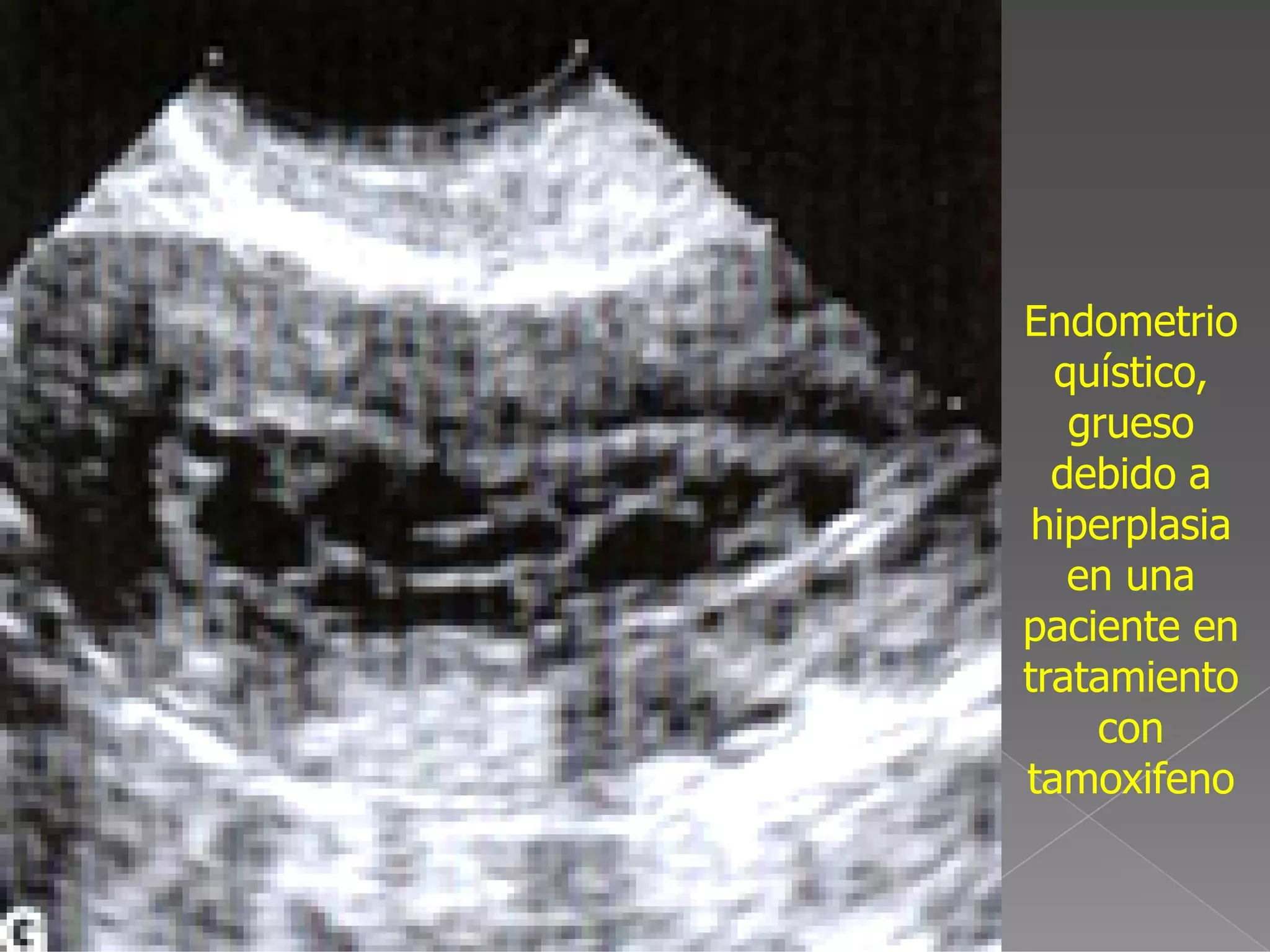 Ecografía del Endometrio | PDF | Pregnancy | Reproductive Health
