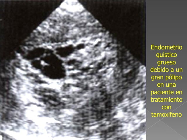 Ecografía del Endometrio | PDF | Pregnancy | Reproductive Health