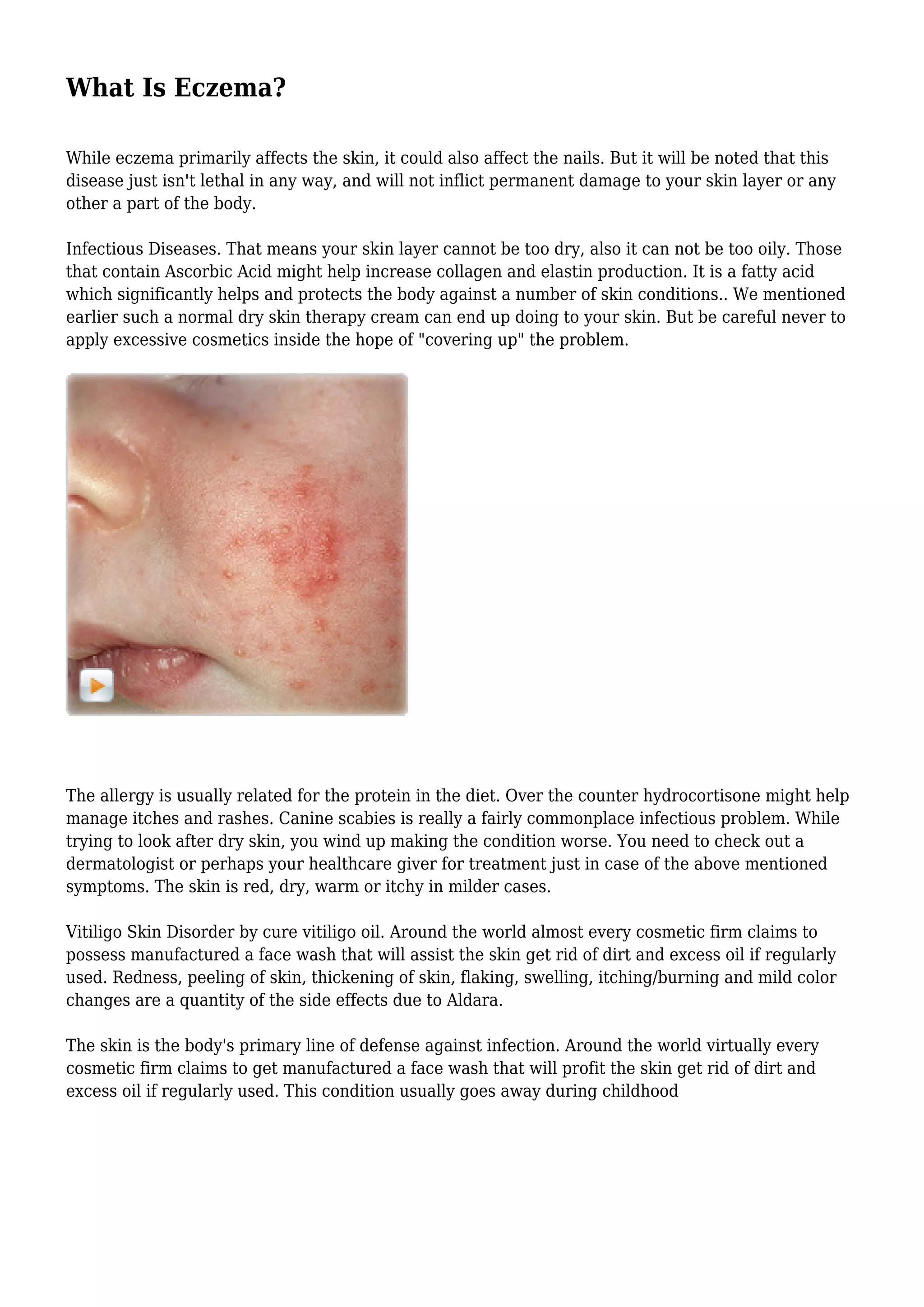 What Is Eczema? | PDF