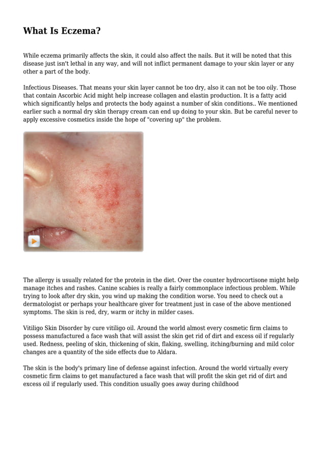 What Is Eczema? | PDF