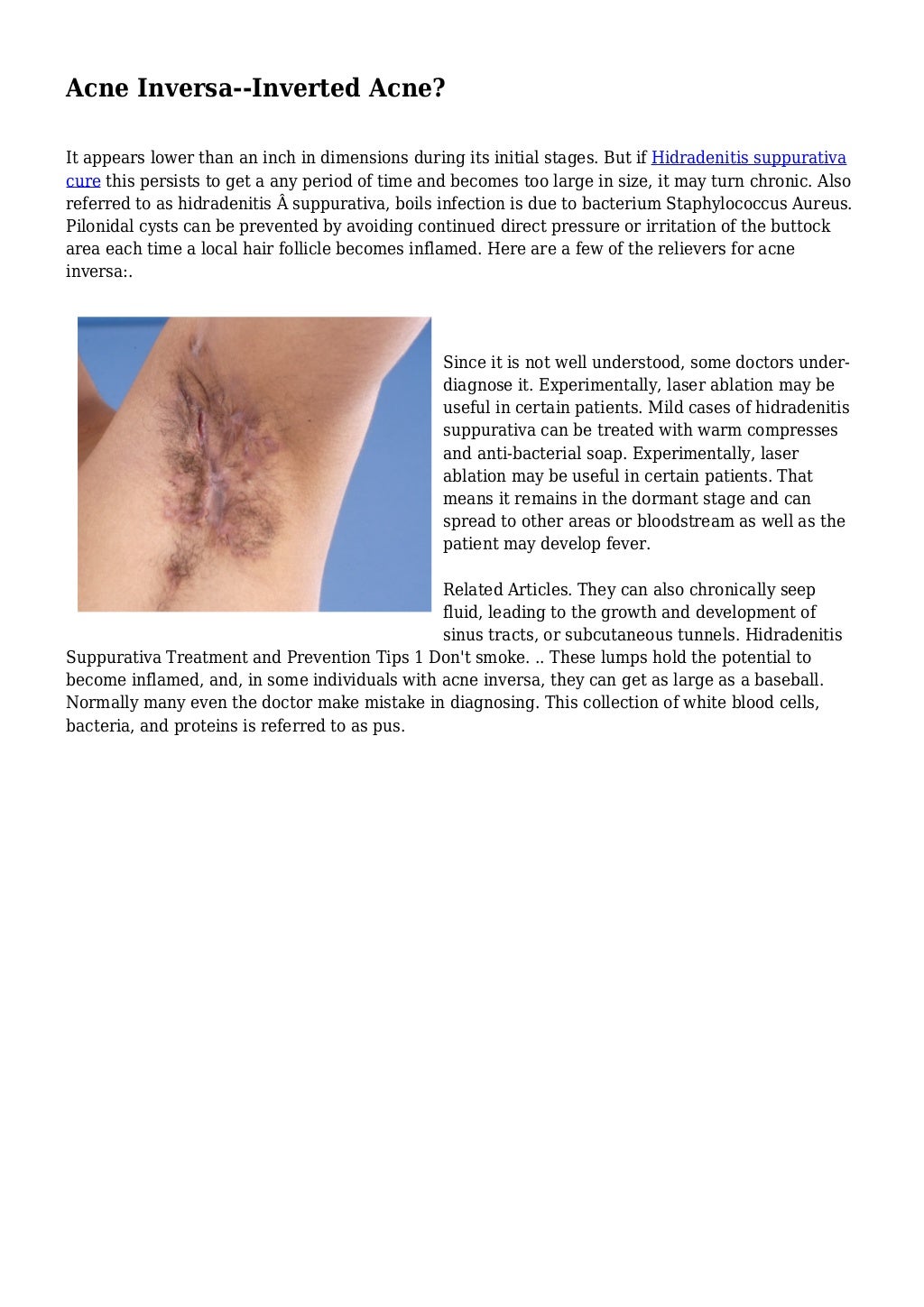 Acne Inversa--Inverted Acne?