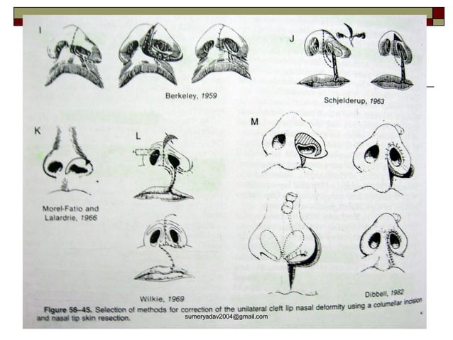 secondary deformities of cleft LIP AND NOSE | PPT | Ear, Nose and ...