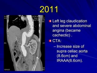 Hybrid repair of Thoracoabdominal Aneurysm | PPTX