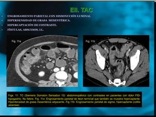 Enfermedad inflamatoria intestinal medicina | PPT