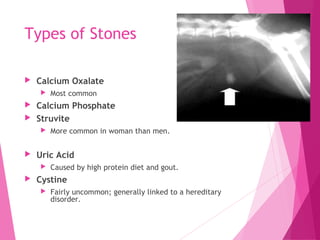 renal stone disease | PPT