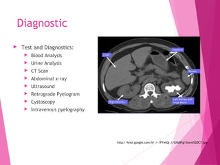 renal stone disease | PPT