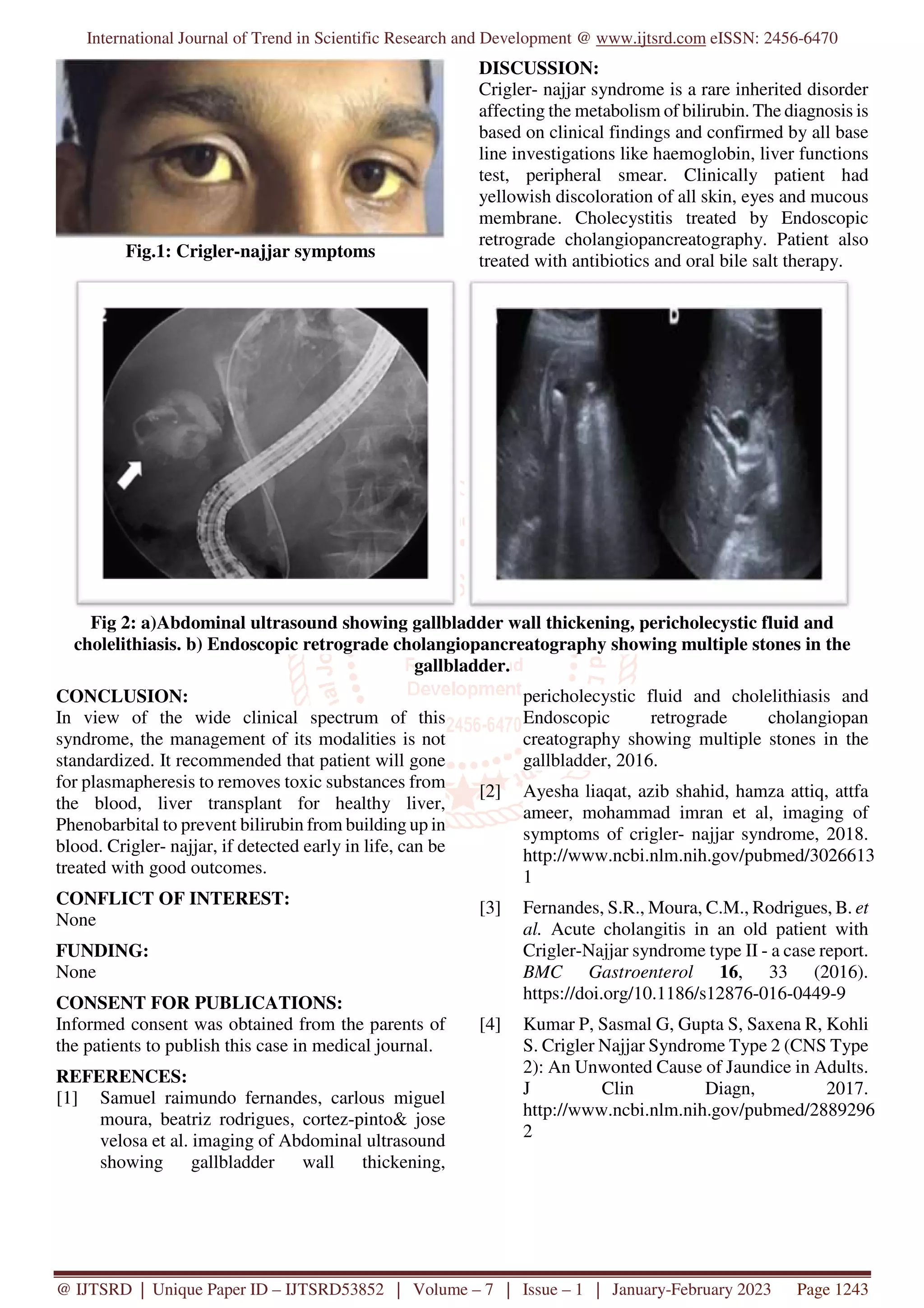 Crigler Najjar Syndrome Case Report | PDF