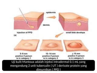 145411900-imunisasi test Mantoux-ppt.ppt