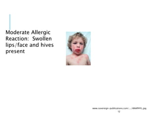 Allergies & Anaphylaxis.ppt