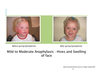 Anaphylaxis Before And After