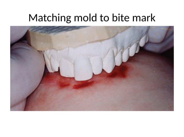 Bite Mark and Teeth Impression Evidences 12 | PPT