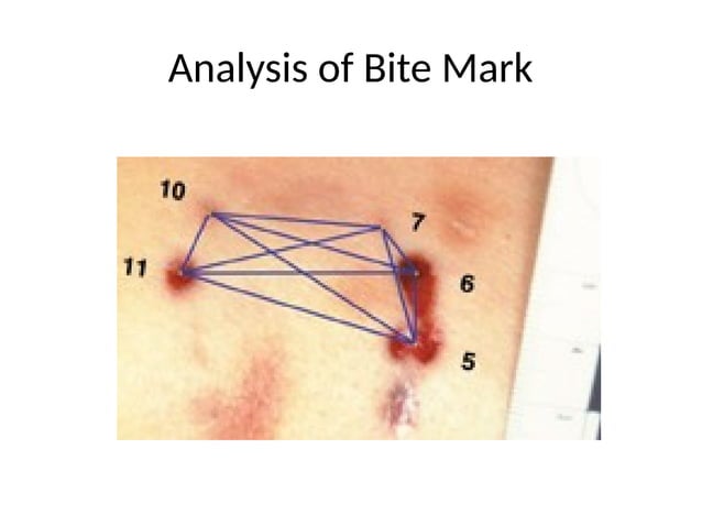 Bite Mark and Teeth Impression Evidences 12 | PPT