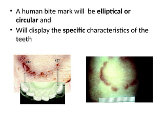 Bite Mark and Teeth Impression Evidences 12 | PPT