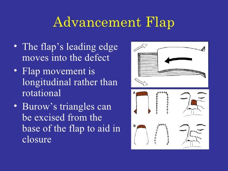 145d Coclia99 Grafts And Flaps