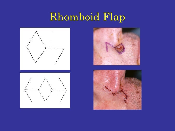 145d Coclia99 Grafts And Flaps