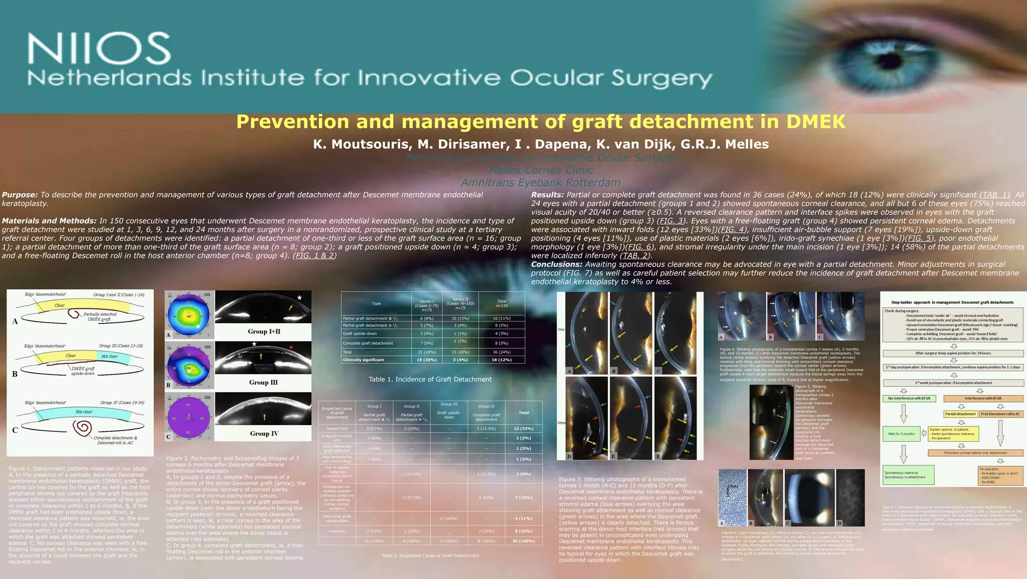 Prevention and management of graft detachment in DMEK | PPTX