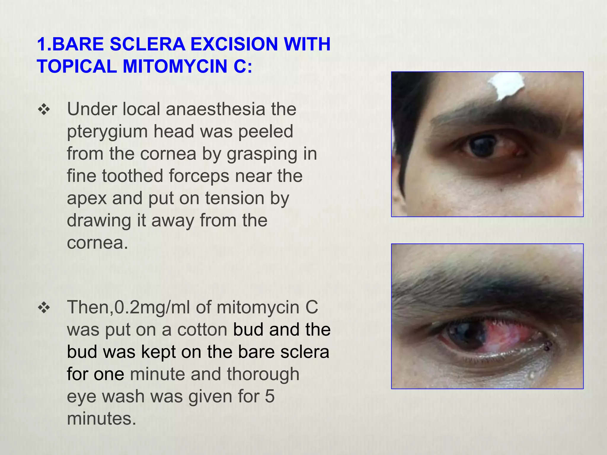 Comparative Study Of Pterygium Excision With Conjunctival Autograft,Wet ...