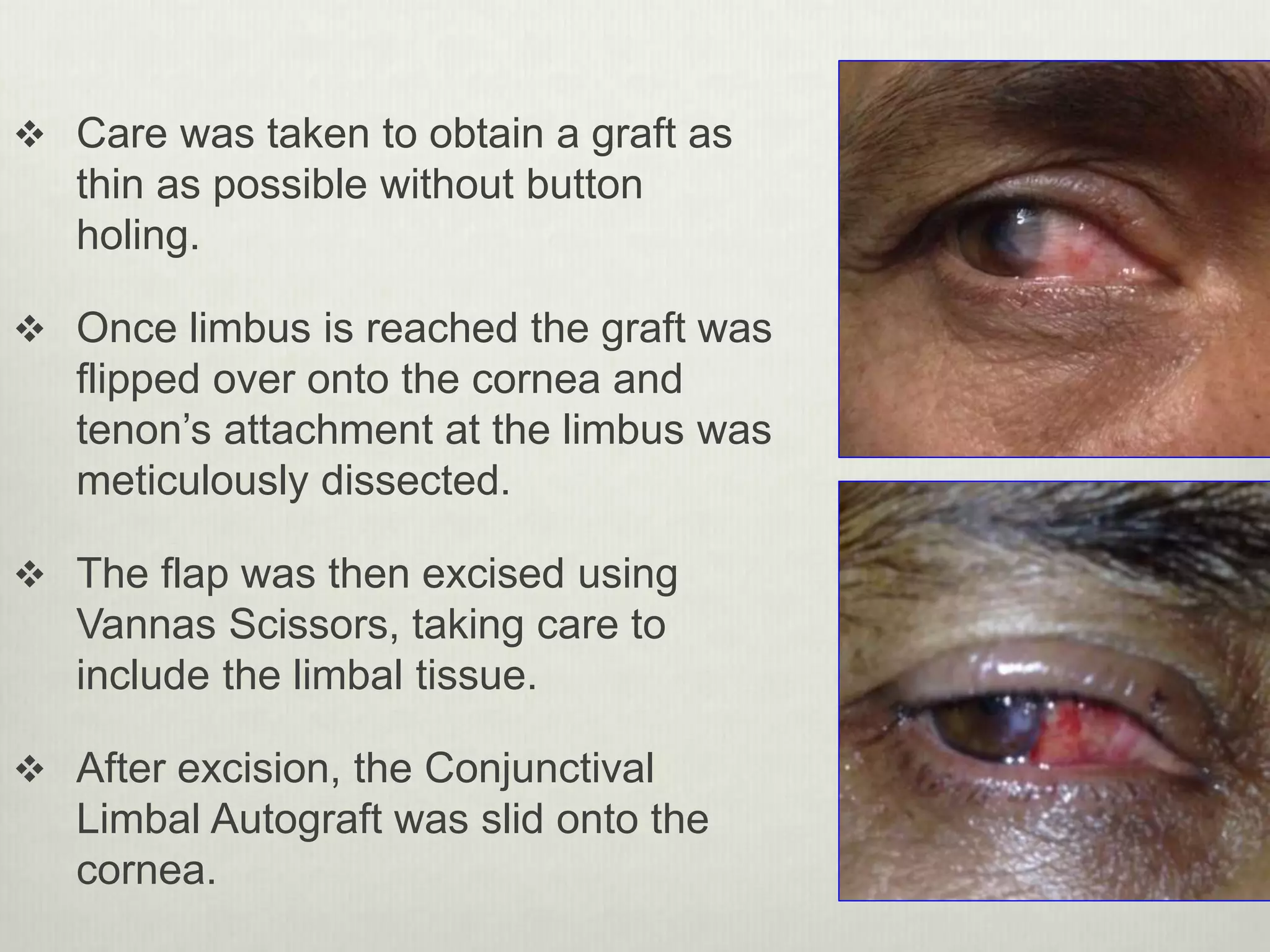 Comparative Study Of Pterygium Excision With Conjunctival Autograft,Wet ...