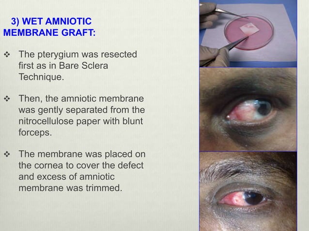 Comparative Study Of Pterygium Excision With Conjunctival Autograft,Wet ...