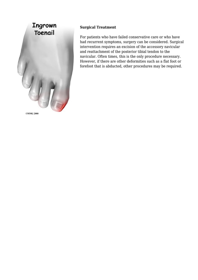 Large Accessory Navicular Bone | PDF