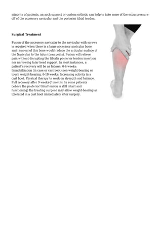 Removal Of Accessory Navicular Bone Recovery | PDF