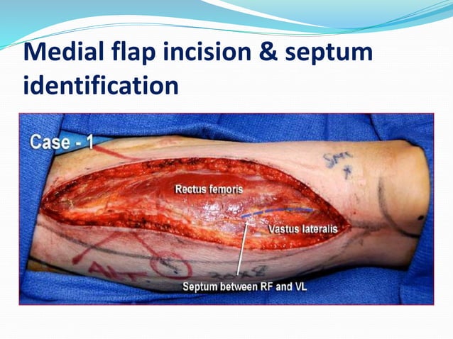 anterolateral thigh flap | PPT