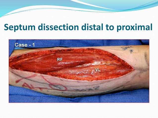 anterolateral thigh flap | PPT