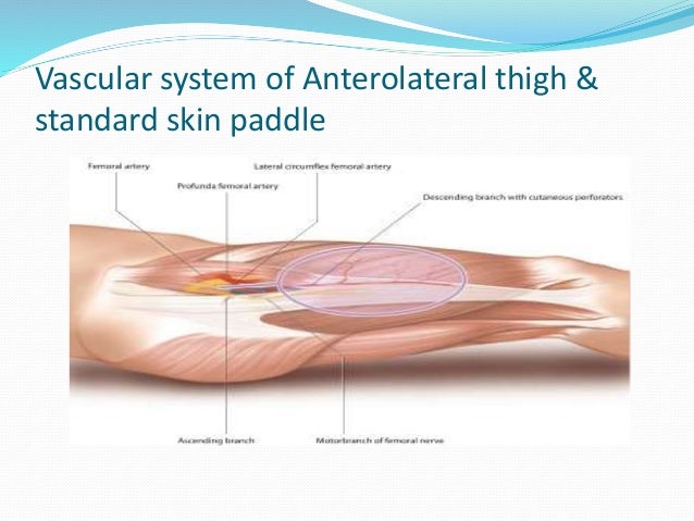 anterolateral thigh flap