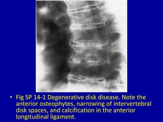 14 calcification of intervertebral disks | PPT