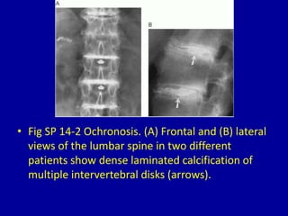 14 calcification of intervertebral disks | PPTX