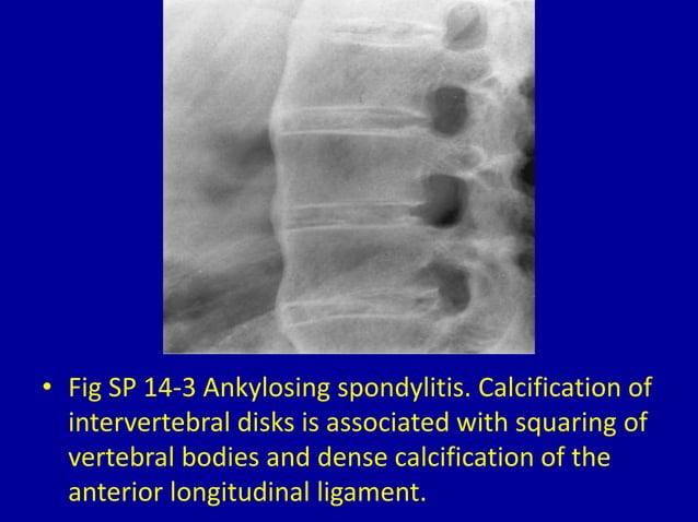 14 calcification of intervertebral disks | PPTX