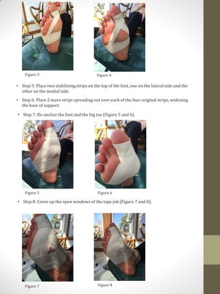 Taping Project | PDF