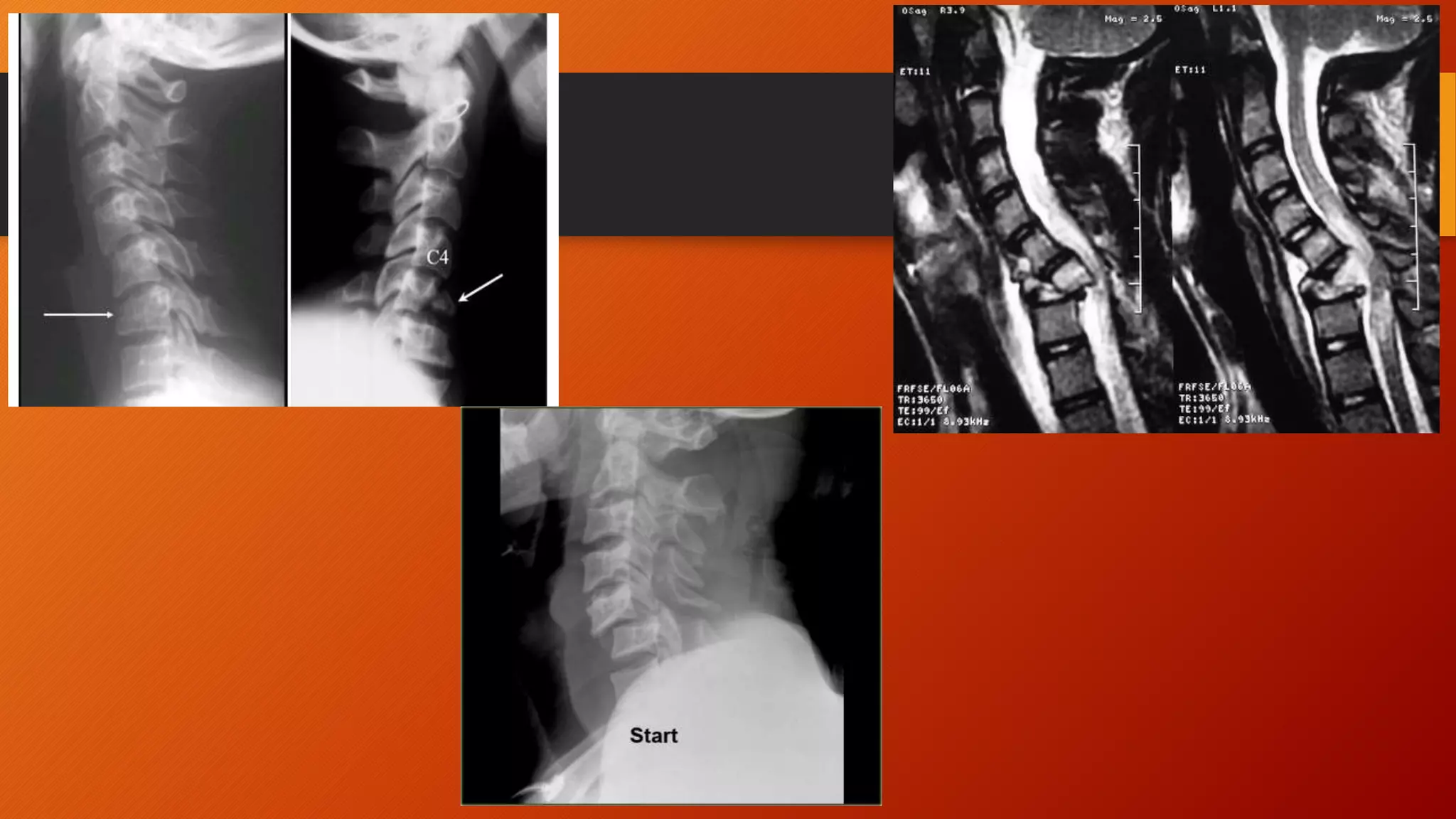14 CERVICAL SPINE TRAUMA.pptx