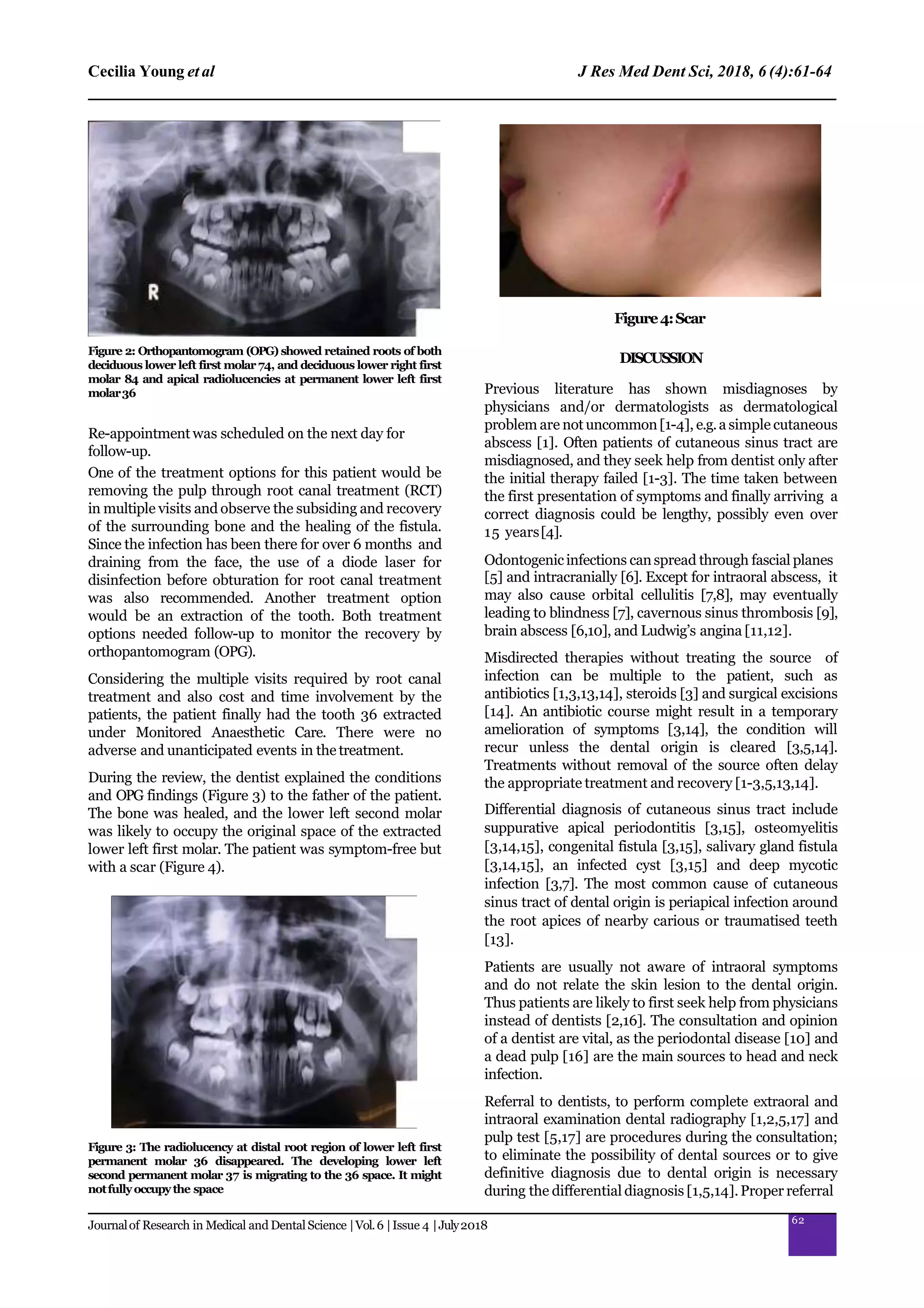 Cutaneous sinus-tract-of-dental-origin-in-an-8yearold-child-a-case ...