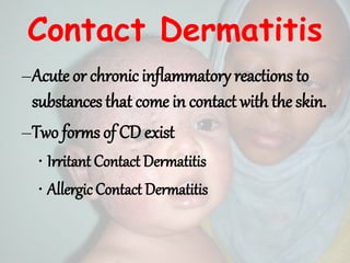 14Dermatitis and Eczema.ppt