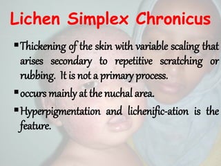 14Dermatitis and Eczema.ppt